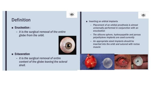 Enucleation, evisceration, exenteration | PPTX | Eye and Vision ...