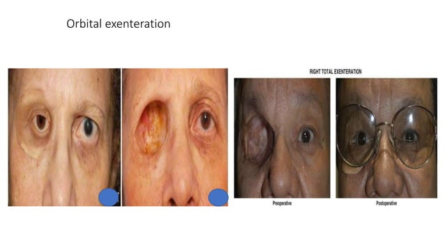 Enucleation, evisceration, exenteration | PPTX | Eye and Vision ...