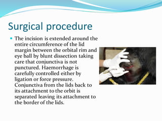 enucleation of eye (2).pdf