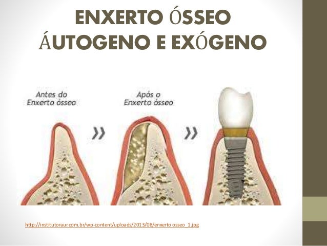 Enxerto autógeno e exogeno co2 - prof. ícaro augusto