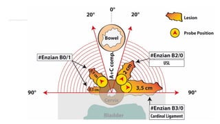ENZIAN-Endometriosis | PDF