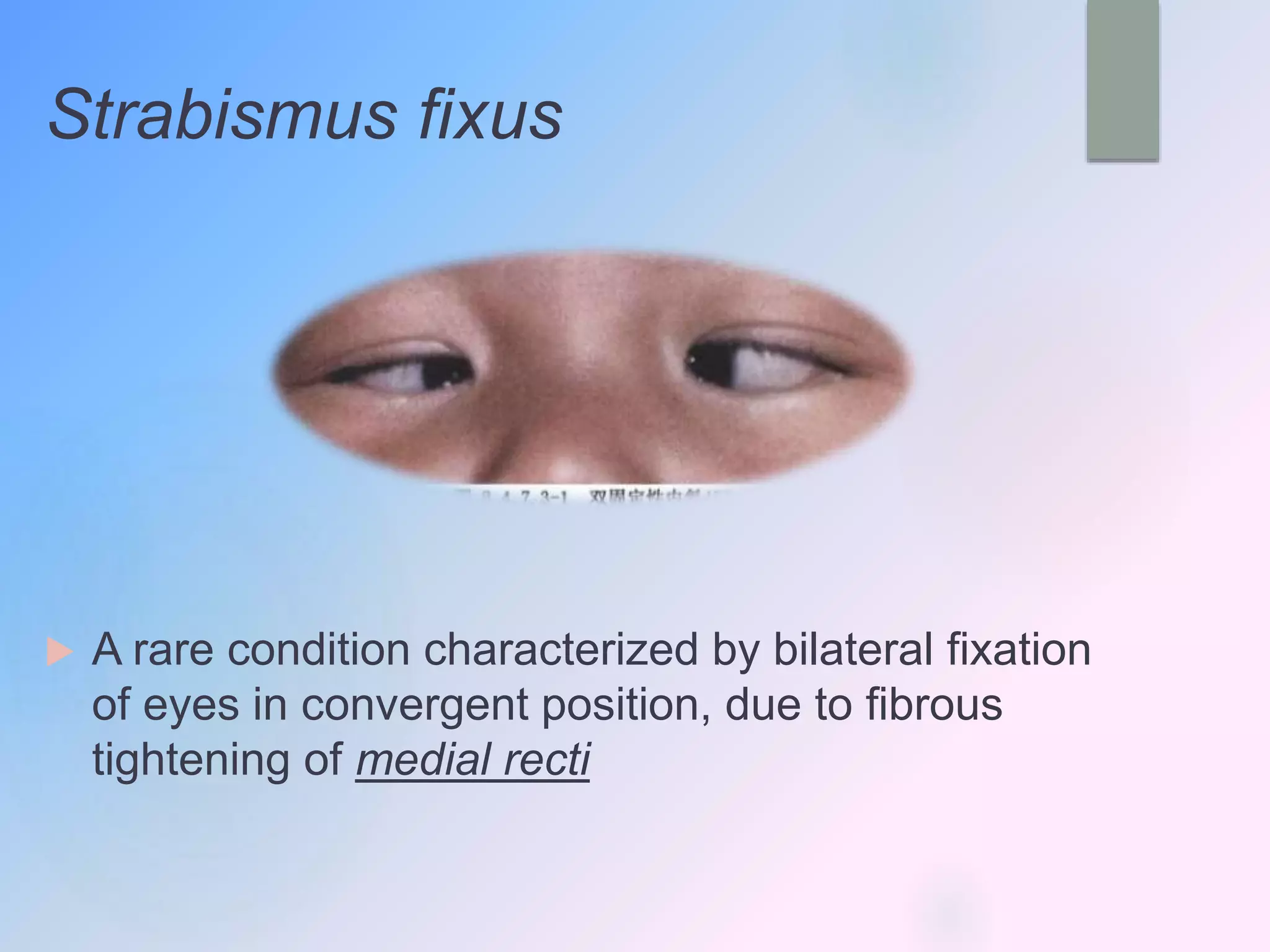 Extraocular Muscles: Anatomy | PPTX