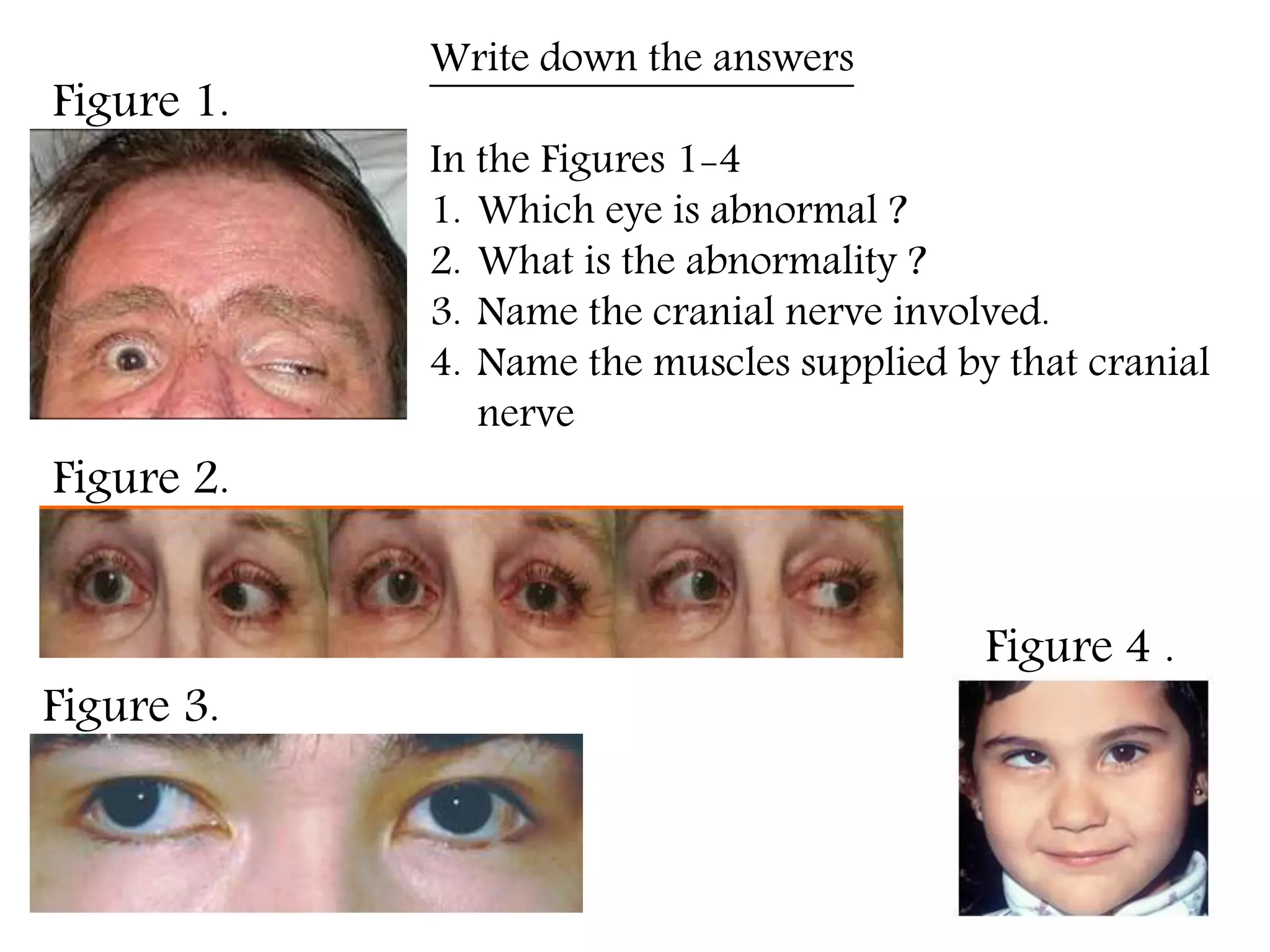 Extra ocular muscles ppt | PPTX