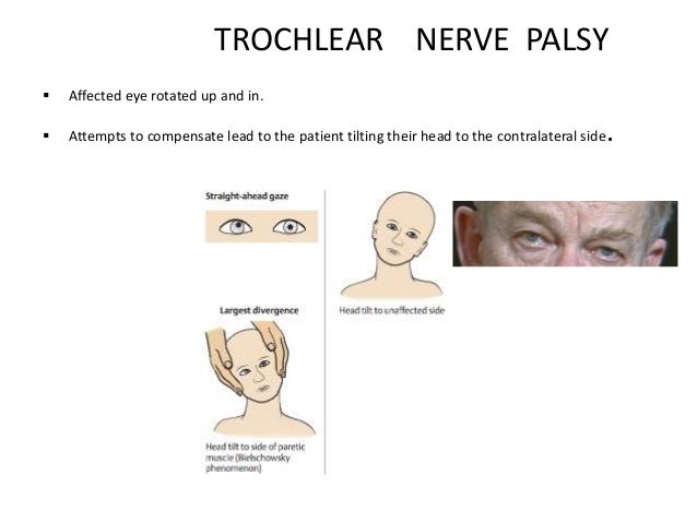 Extra ocular muscles ppt