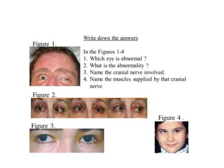 Extraocular muscles movement and test in ocular | PPTX