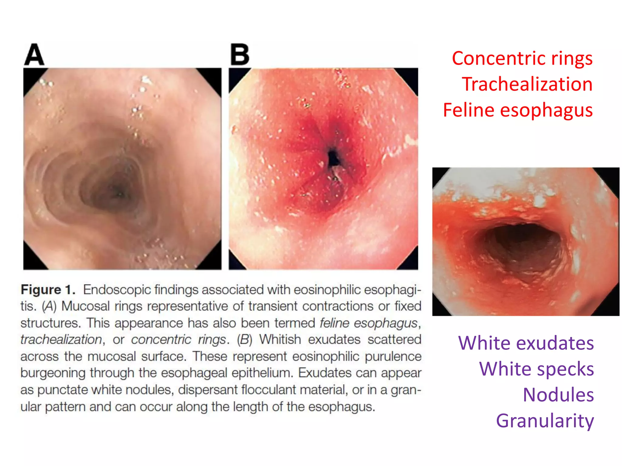 Eosinophilic esophagitis | PDF
