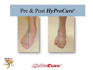 HyProCure Before & After | PPT