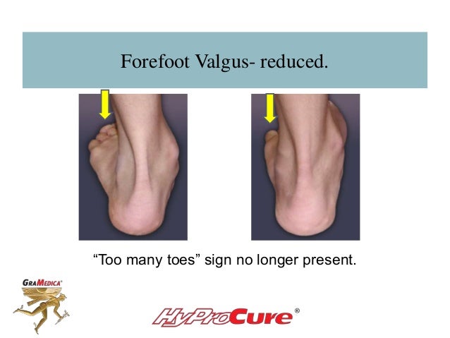 HyProCure Before & After