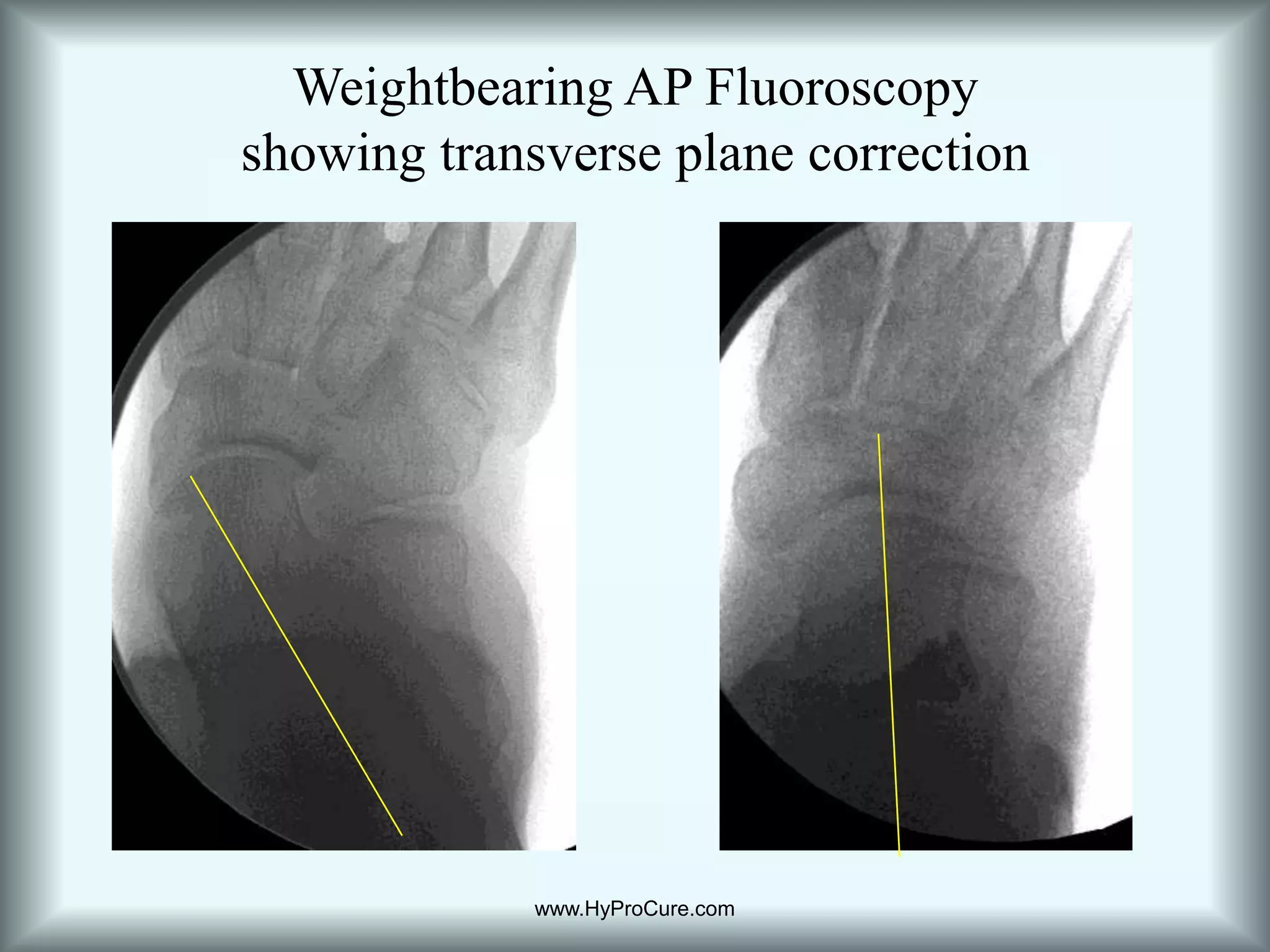 HyProCure Before & After | PPTX