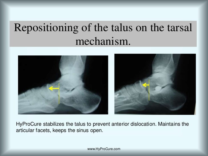 HyProCure Before & After
