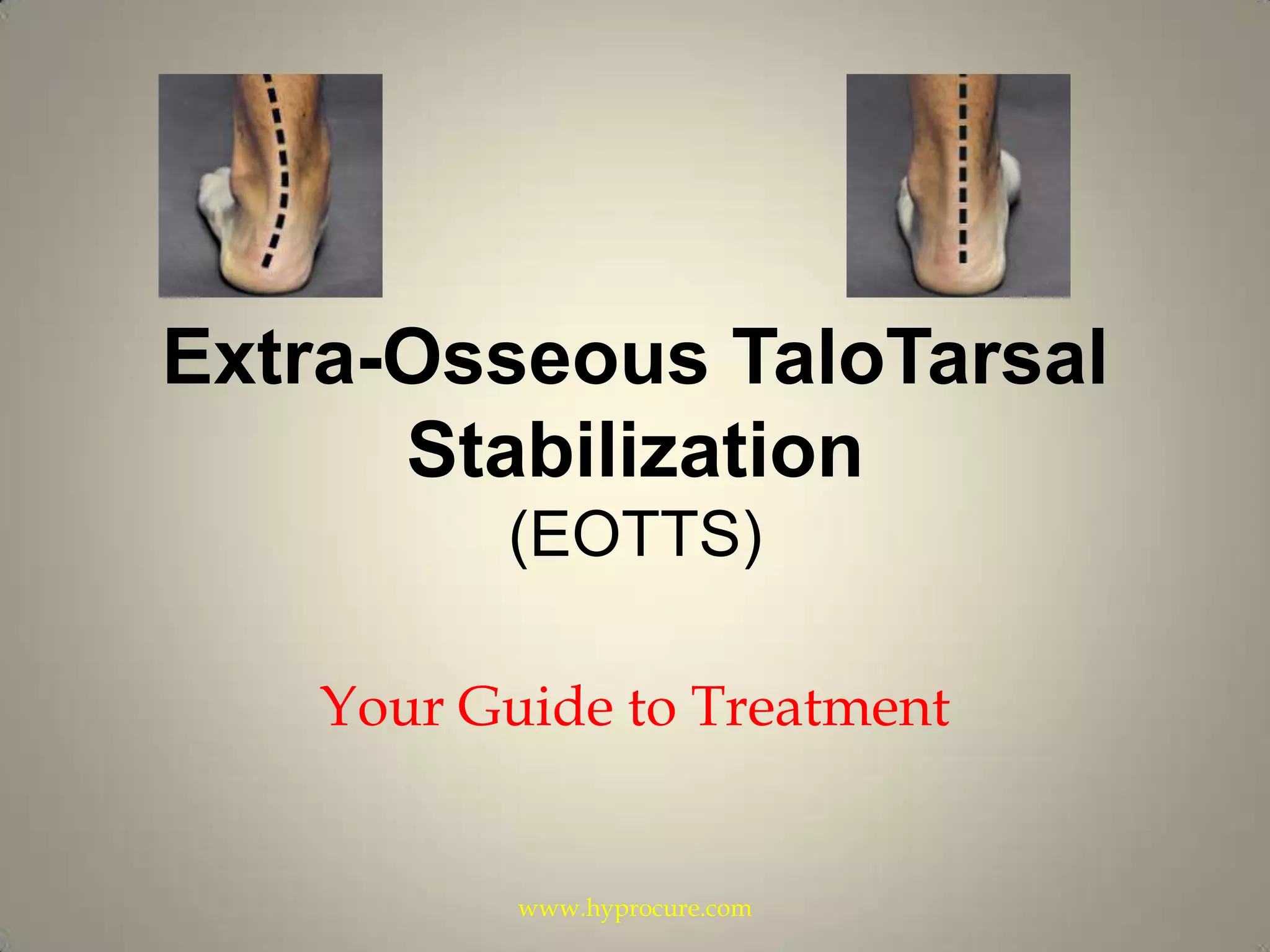Extra-Osseous TaloTarsal Stabilization Treatment Guide | PPT