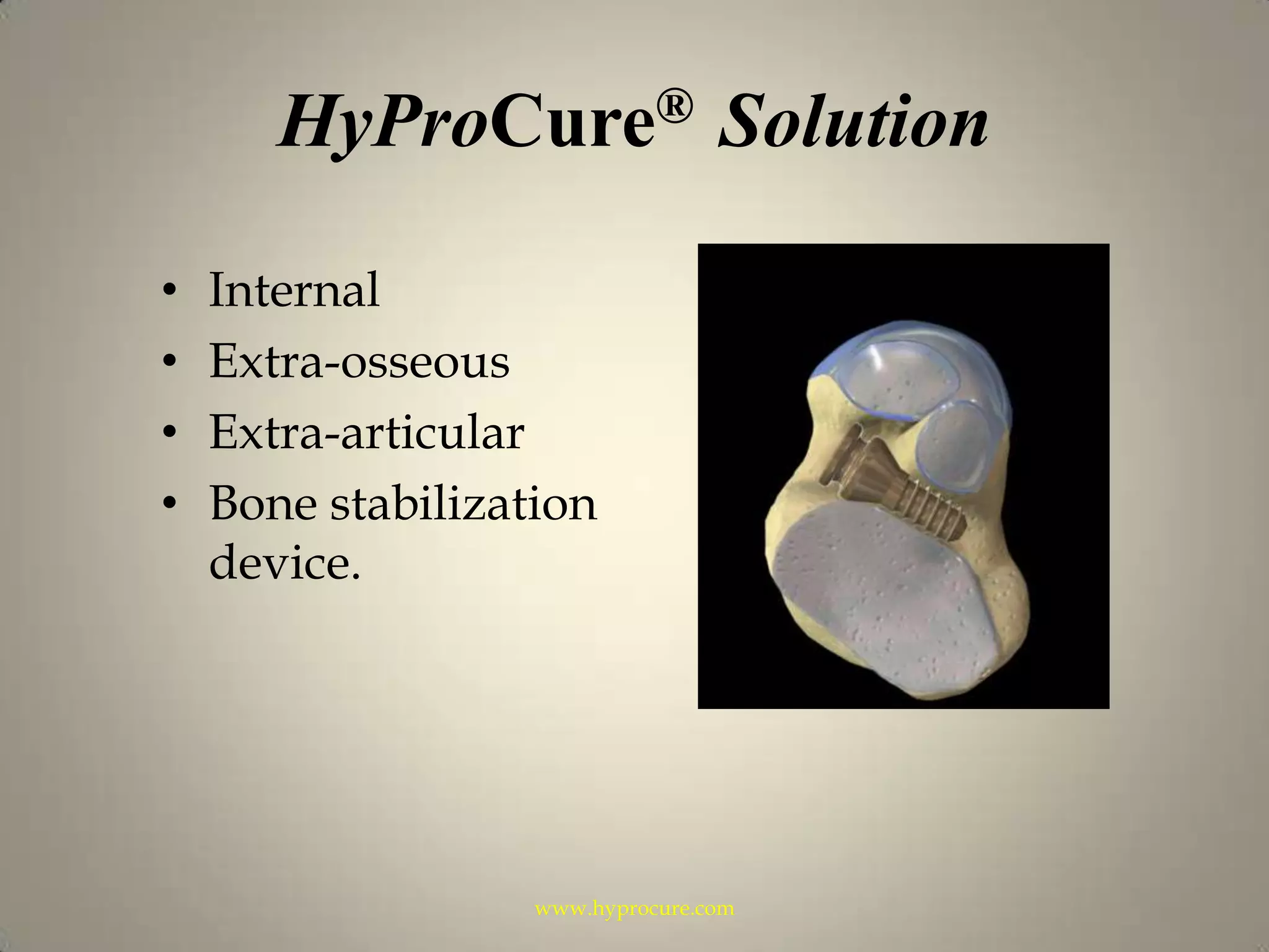Extra-Osseous TaloTarsal Stabilization Treatment Guide | PPTX