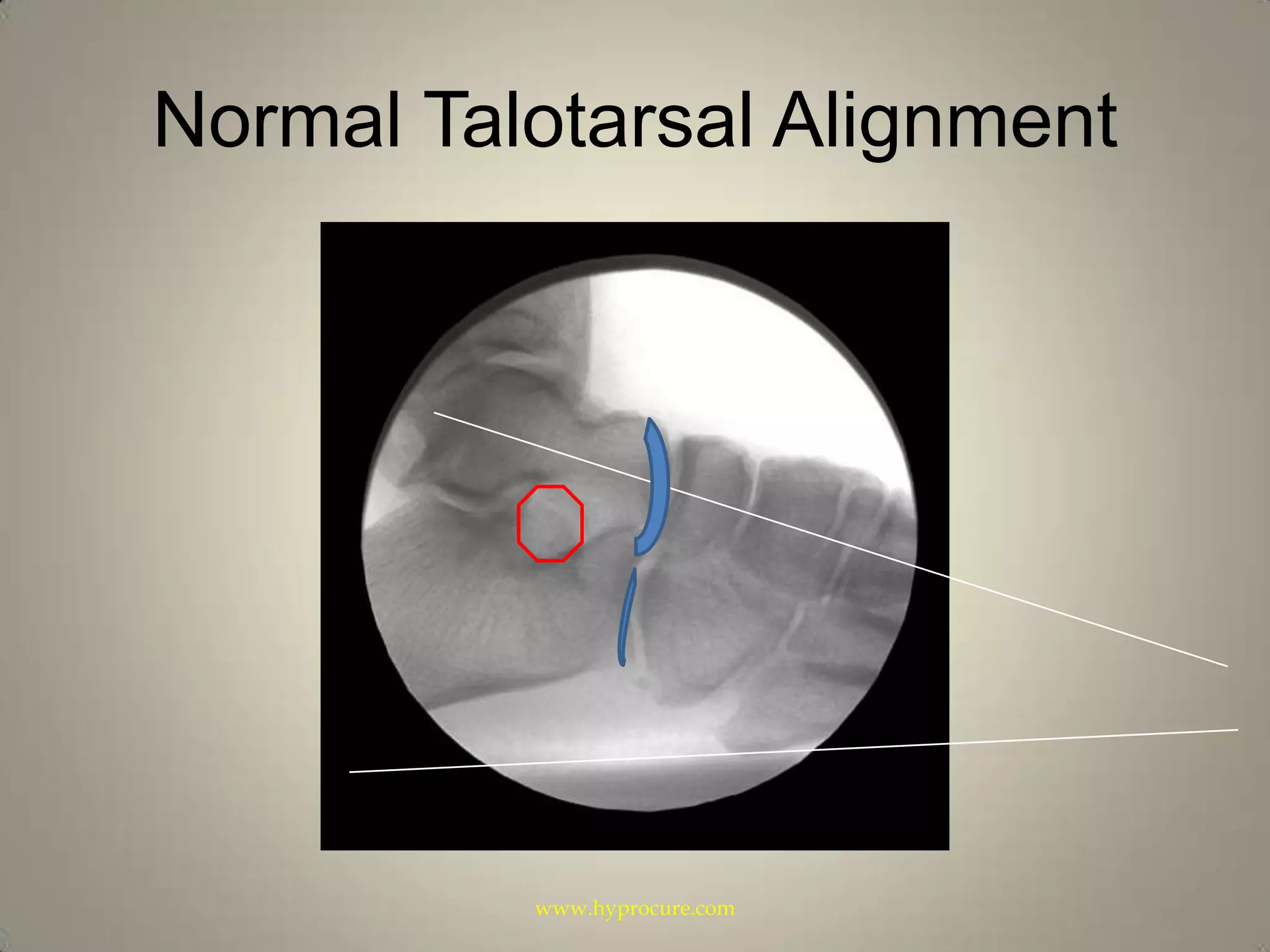 Extra-Osseous TaloTarsal Stabilization Treatment Guide | PPTX