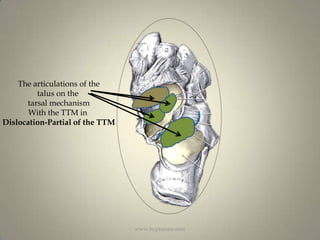 Extra-Osseous TaloTarsal Stabilization Treatment Guide | PPT
