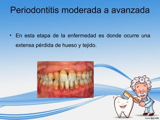 Enfermedades periodontales | PPT