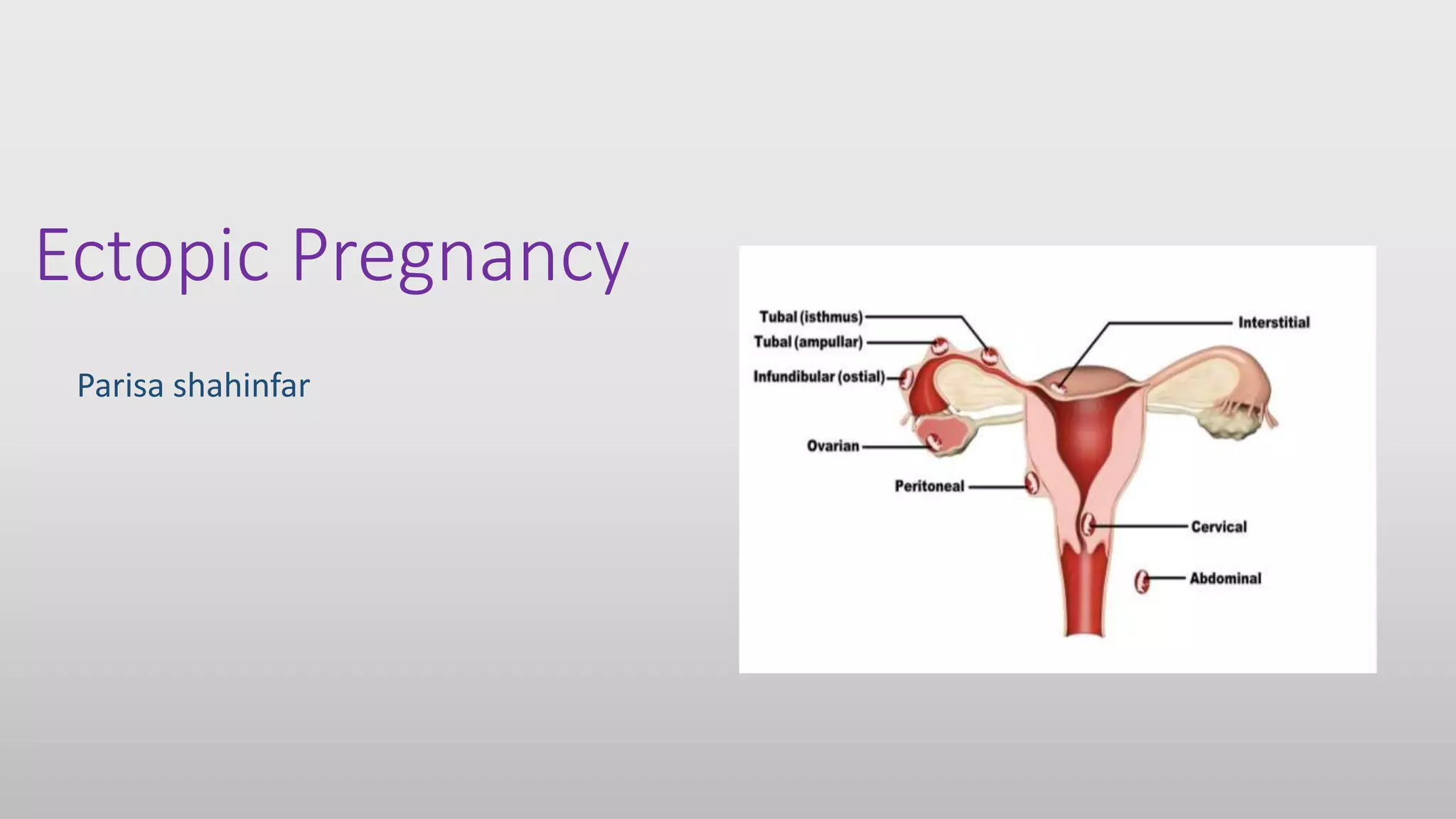 Ectopic pregnancy | PPTX
