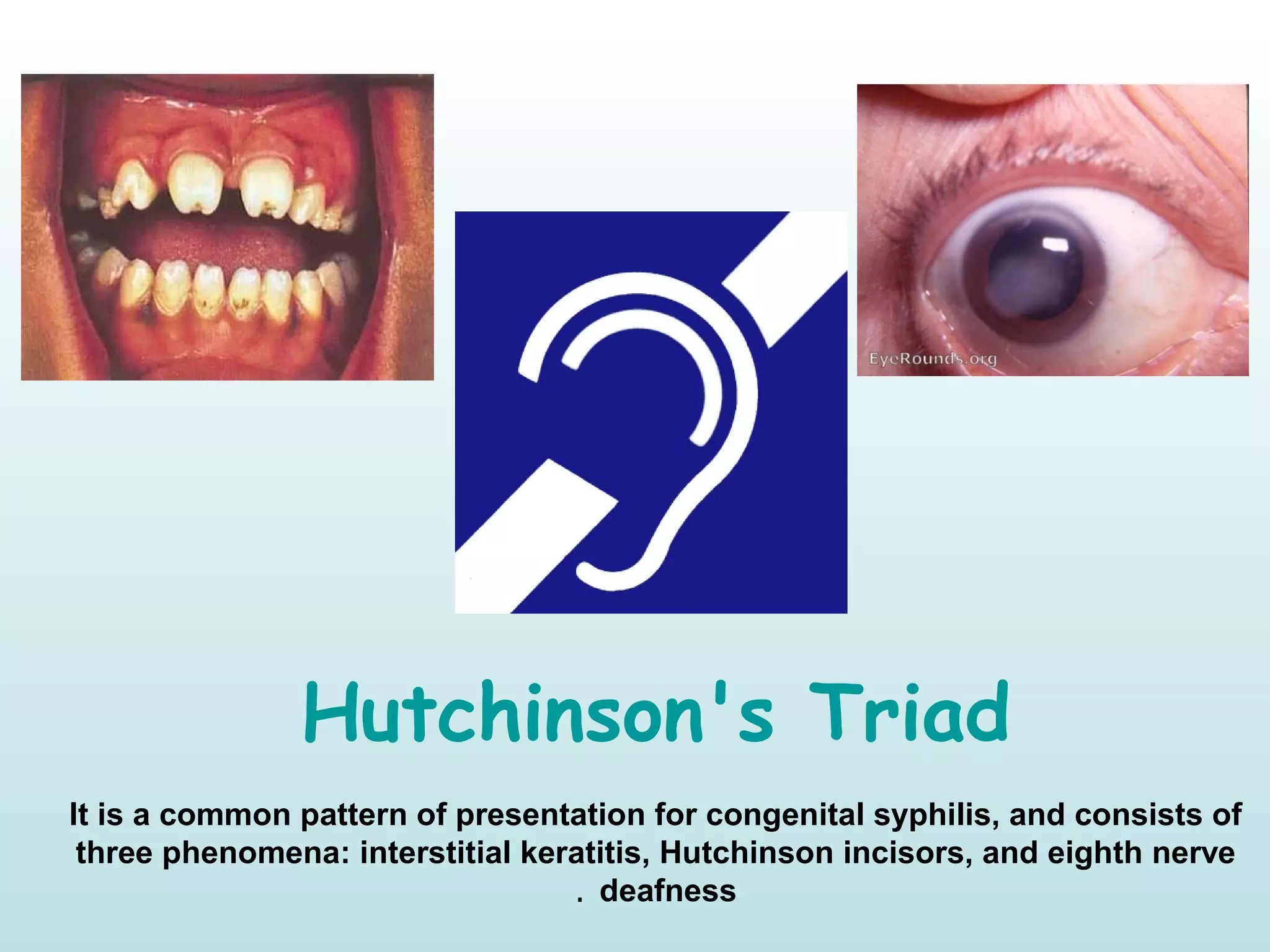 Ophthalmology Eponyms II ! | PPT