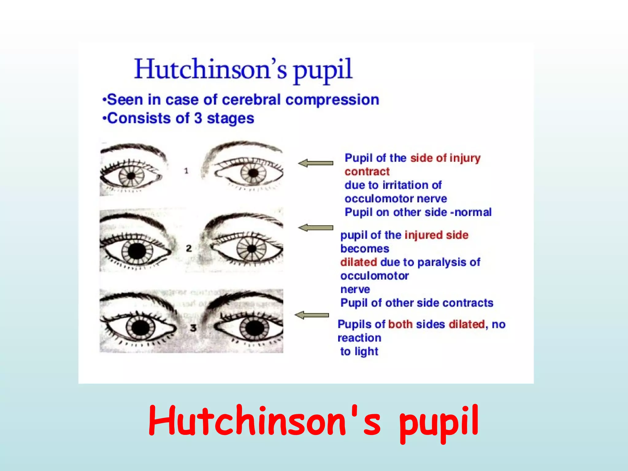 Ophthalmology Eponyms II ! | PPT