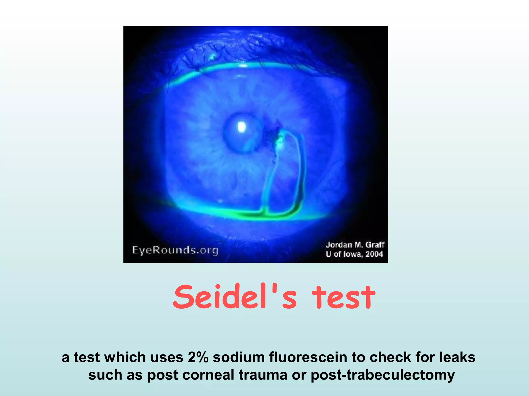Ophthalmology Eponyms II ! | PPT