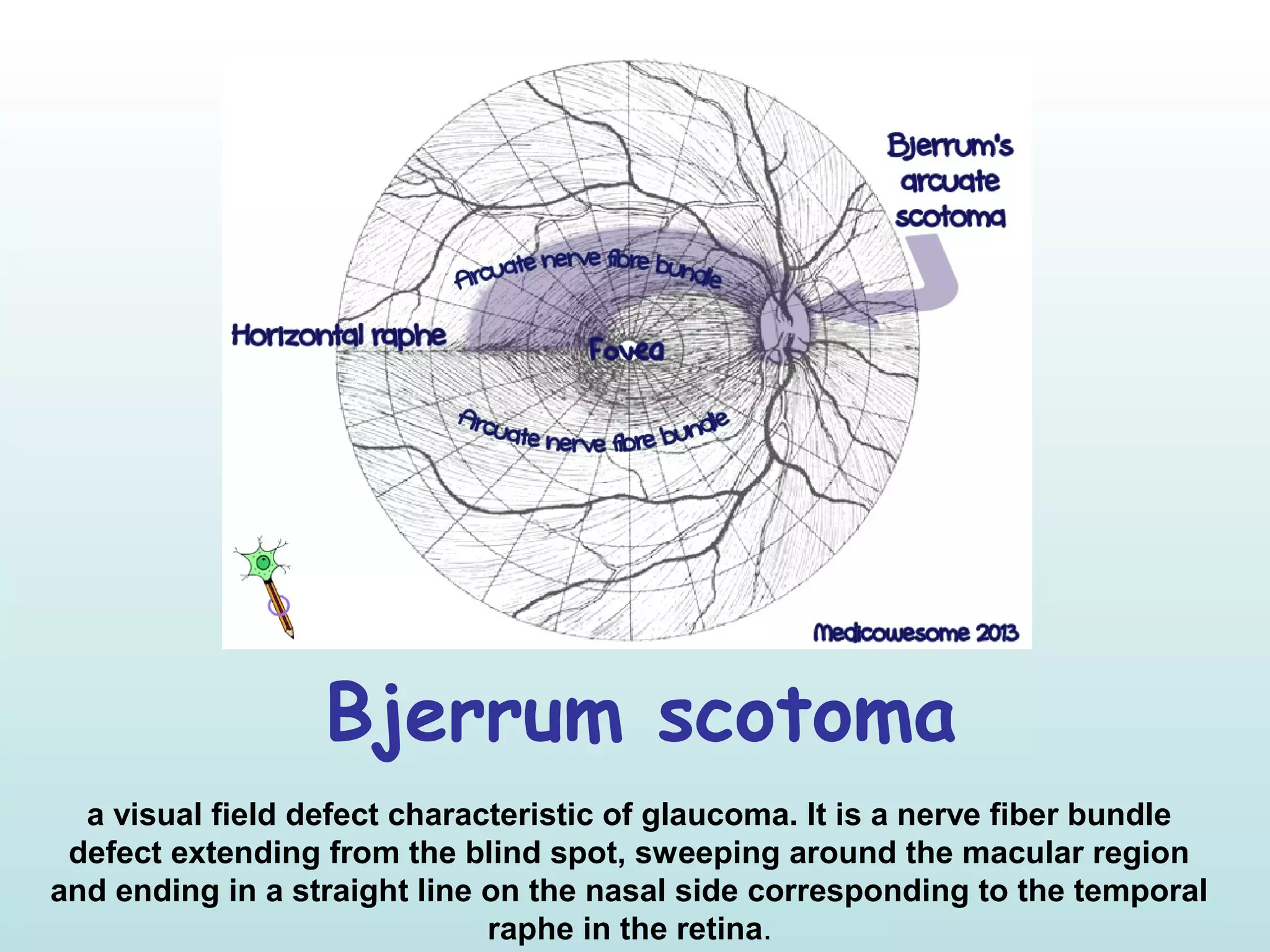 Ophthalmology Eponyms II ! | PPT