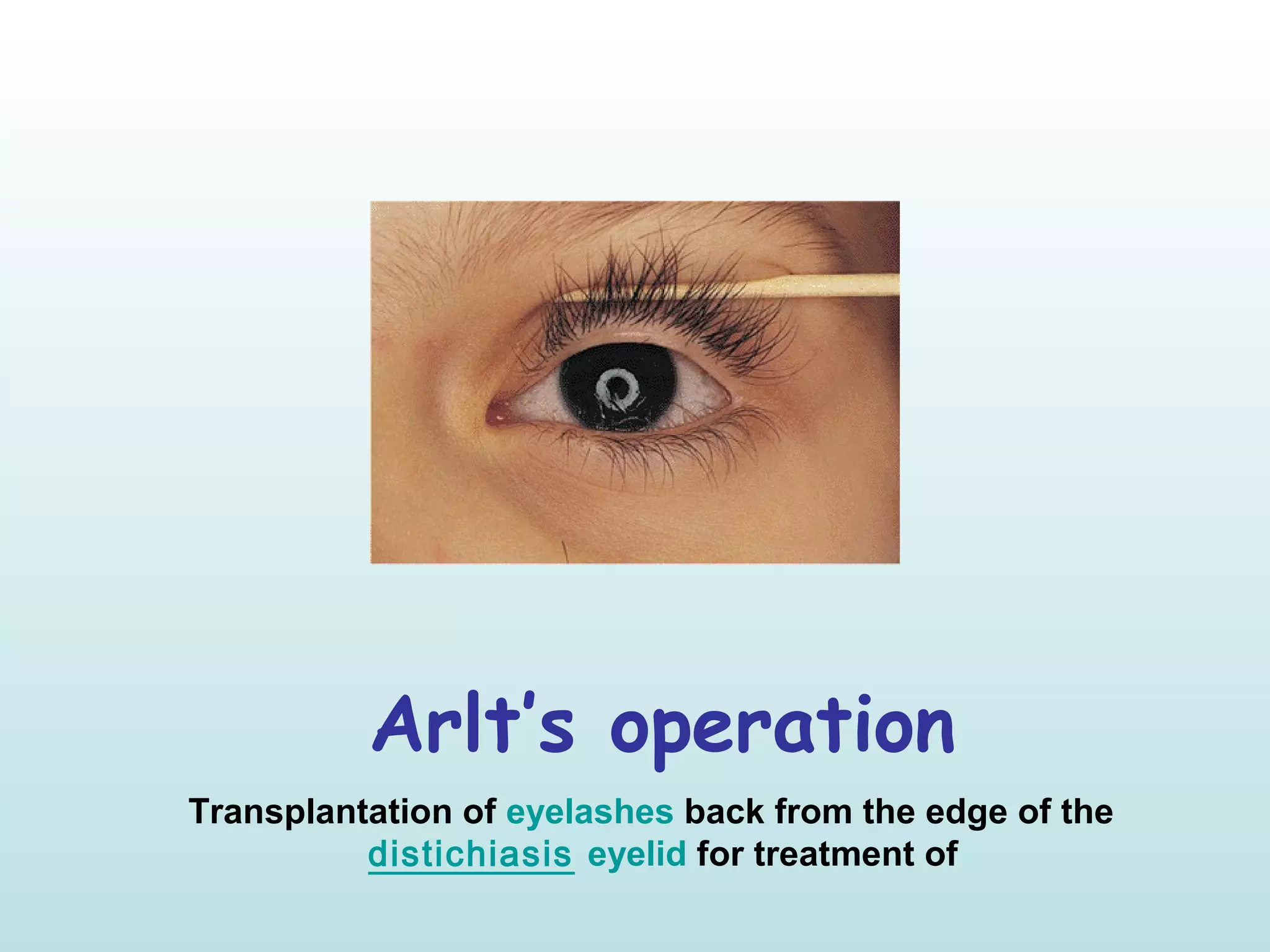 Ophthalmology Eponyms II ! | PPT