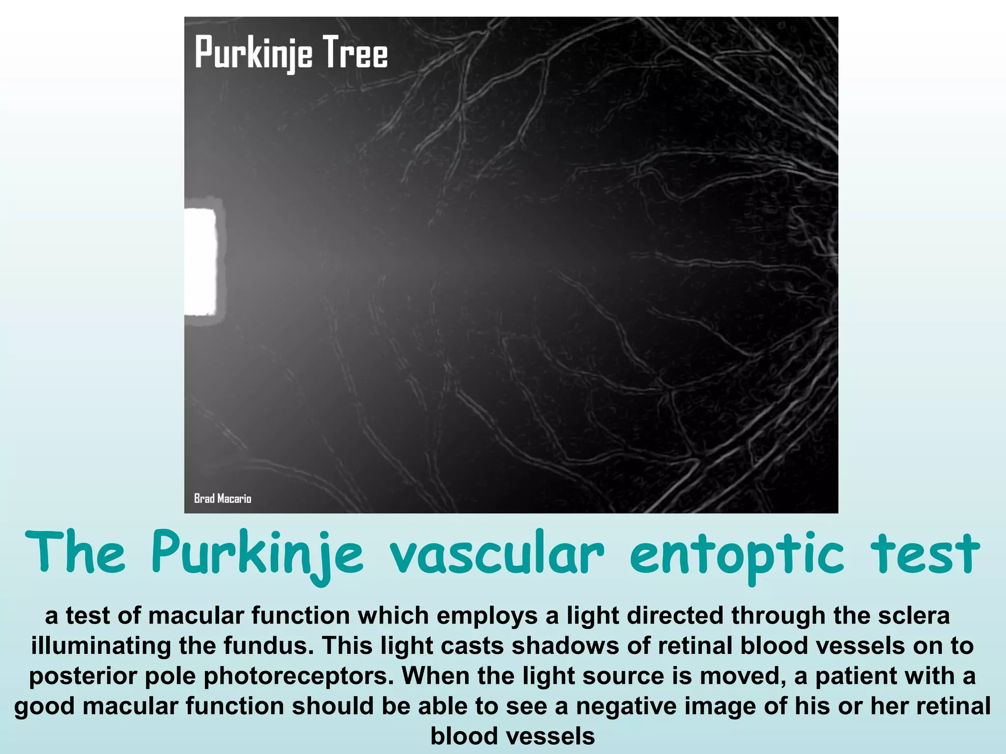 Ophthalmology Eponyms II ! | PPT