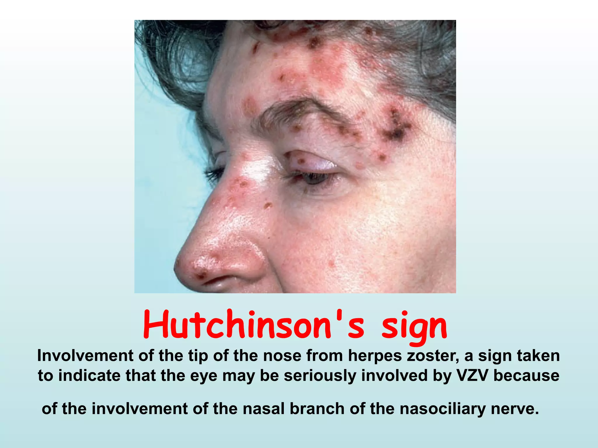 Ophthalmology Eponyms II ! | PPT