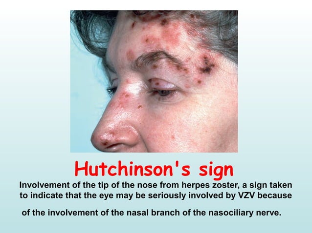 Ophthalmology Eponyms II ! | PPT | Eye and Vision Conditions | Diseases ...