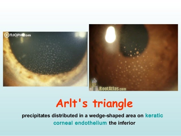 Ophthalmology Eponyms II