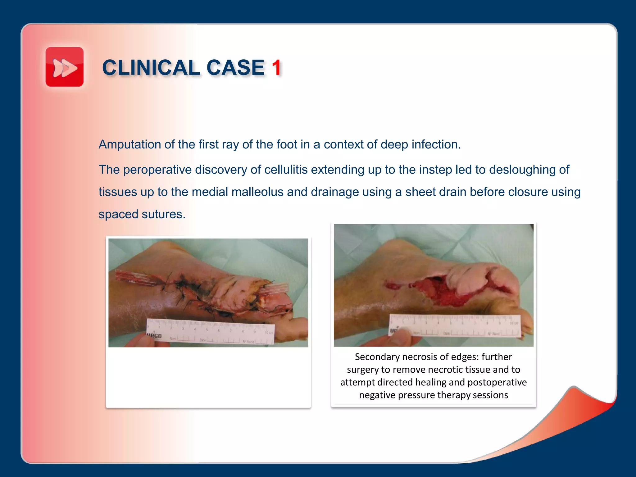 EWMA 2013 - Ep459 - EXPERIENCE WITH A TLC-NOSF DRESSING* IN THE ...