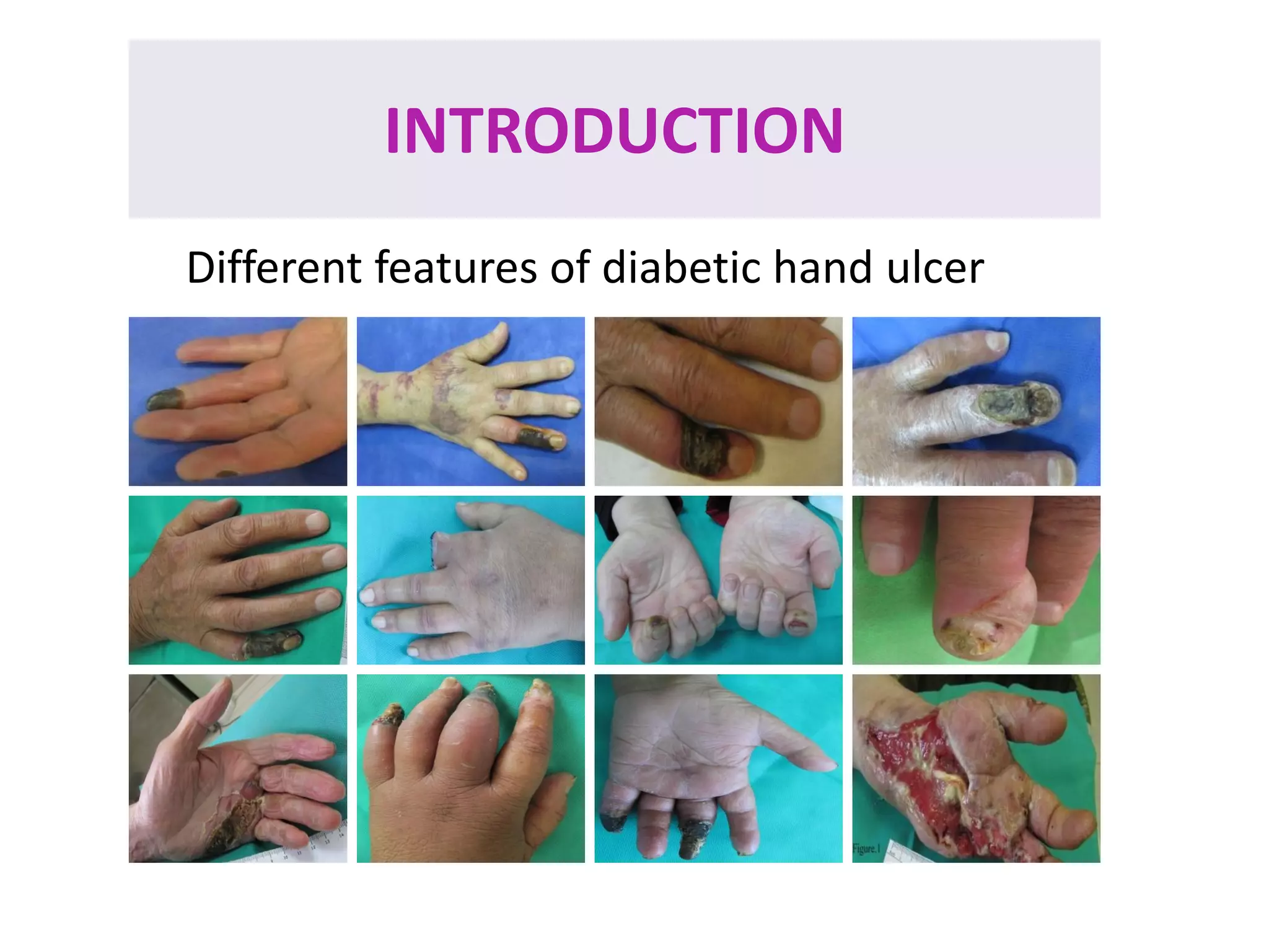 EWMA 2013 - Ep461 - DIABETIC HAND ULCER :A BRIEF REPORT FROM IRAN | PDF ...