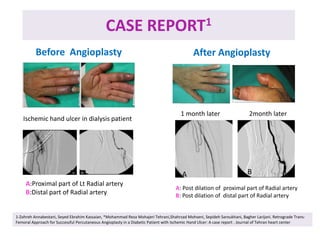 EWMA 2013 - Ep461 - DIABETIC HAND ULCER :A BRIEF REPORT FROM IRAN | PDF