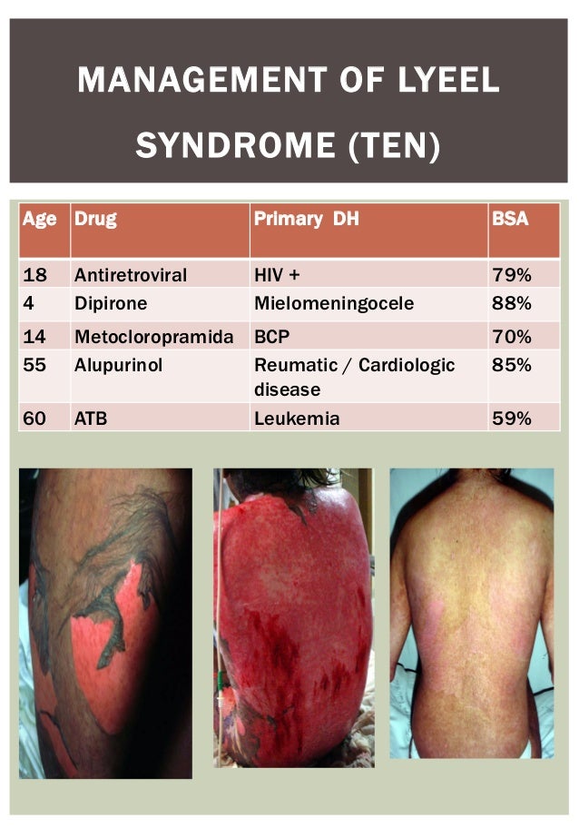 EWMA 2014 - EP463 MANAGEMENT OF LYEEL SYNDROME (TEN)