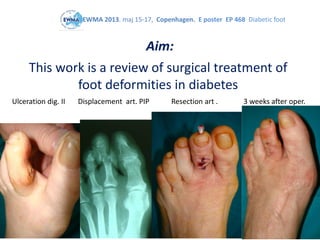 EWMA 2013 - Ep468 - Corrective treatment of deformities in diabetic ...