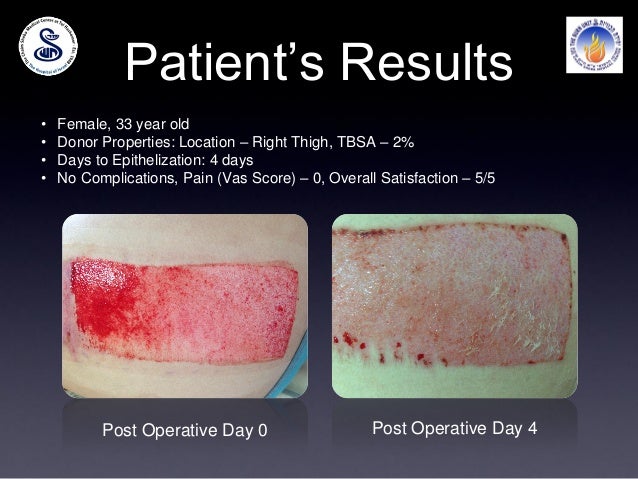 EWMA 2013 - Ep476 - Treatment of Split Thickness Skin Graft Donor Sit…