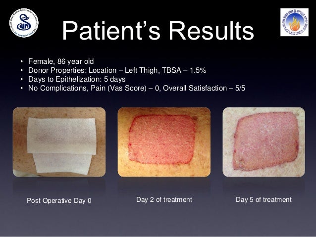 EWMA 2013 - Ep476 - Treatment of Split Thickness Skin Graft Donor Sit…