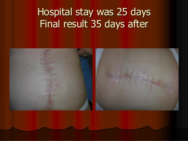 EWMA 2013 - Ep507 - CONSERVATIVE MANAGEMENT OF MESH SITE INFECTION IN…