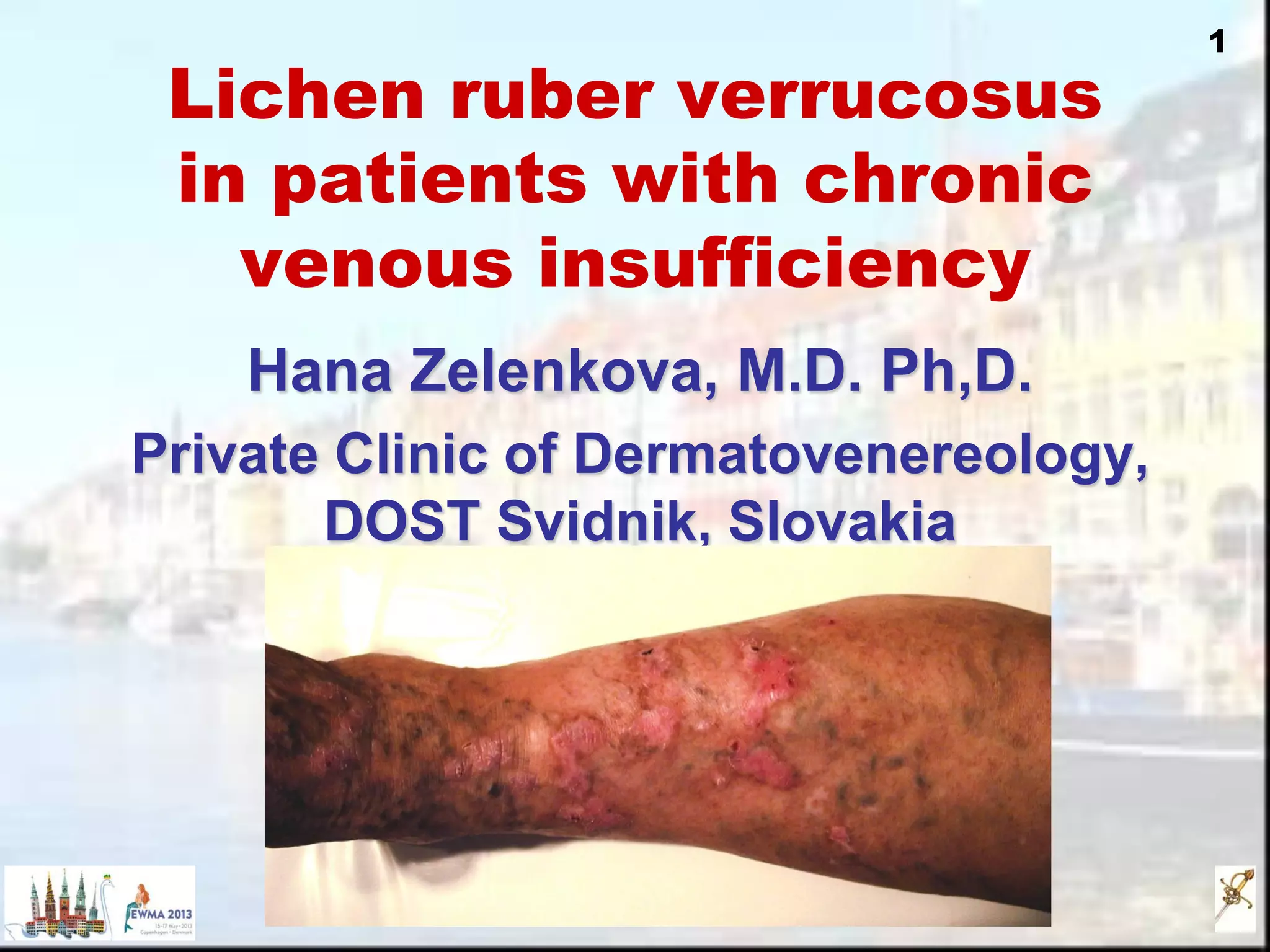 EWMA 2013 - Ep511 - Lichen ruber verrucosus in patients with chronic ...