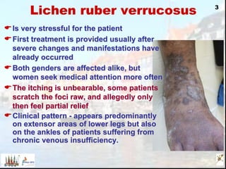 EWMA 2013 - Ep511 - Lichen ruber verrucosus in patients with chronic ...