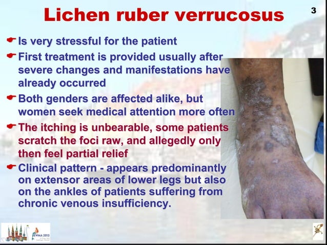 EWMA 2013 - Ep511 - Lichen ruber verrucosus in patients with chronic ...