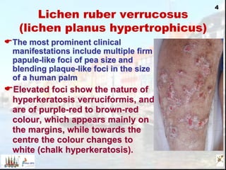 EWMA 2013 - Ep511 - Lichen ruber verrucosus in patients with chronic ...