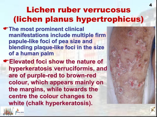 EWMA 2013 - Ep511 - Lichen ruber verrucosus in patients with chronic ...
