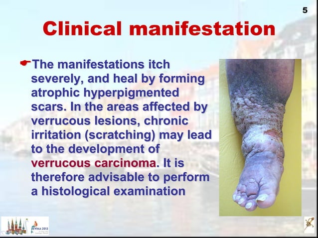 EWMA 2013 - Ep511 - Lichen ruber verrucosus in patients with chronic ...