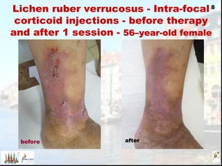 EWMA 2013 - Ep511 - Lichen ruber verrucosus in patients with chronic ...