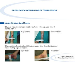 EWMA 2013 - Ep515 - PROBLEMATIC WOUNDS UNDER COMPRESSION EXPERIENCES IN ...