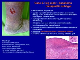 EWMA 2013 - Ep519 - DIFFERENTIAL DIAGNOSIS OF LEG ULCERS - ULCERS OF ...