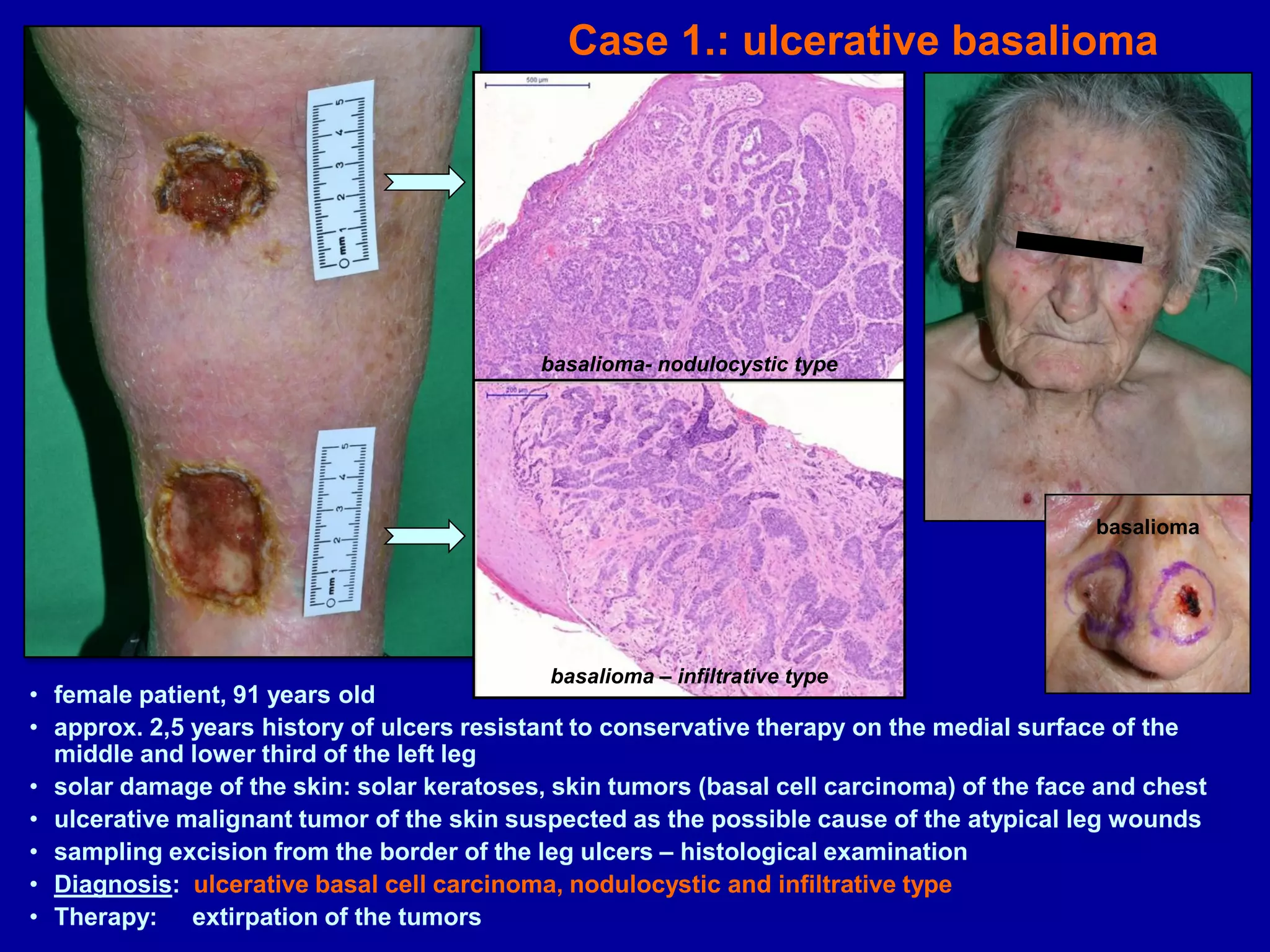 EWMA 2013 - Ep519 - DIFFERENTIAL DIAGNOSIS OF LEG ULCERS - ULCERS OF ...