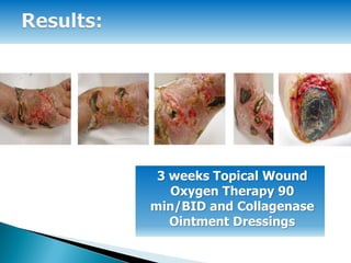 EWMA 2013 - Ep522 The Use of Topical Oxygen in a Complicated Acute ...