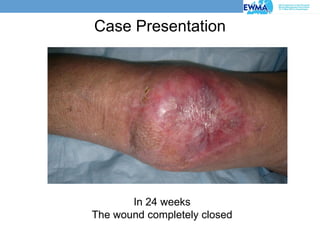 EWMA 2013 - Ep552 - THE USE OF URINARY BLADDER MATRIX (ACELL) IN THE ...