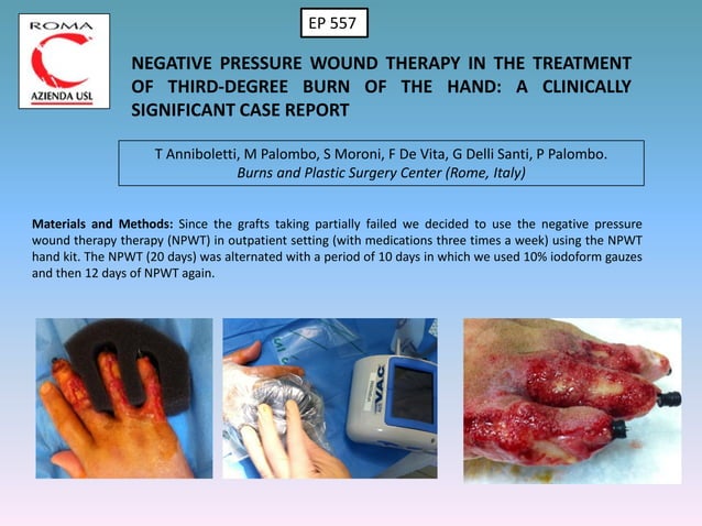 EWMA 2013 - Ep557 - NEGATIVE PRESSURE WOUND THERAPY IN THE TREATMENT OF ...
